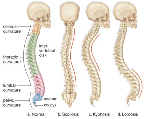 Spinal Curve Correction - Evolved Spine Chiropractic